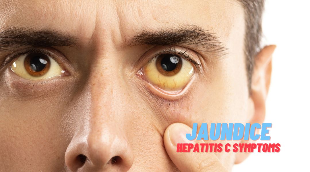Symptoms of Hepatitis C - World HIV Day